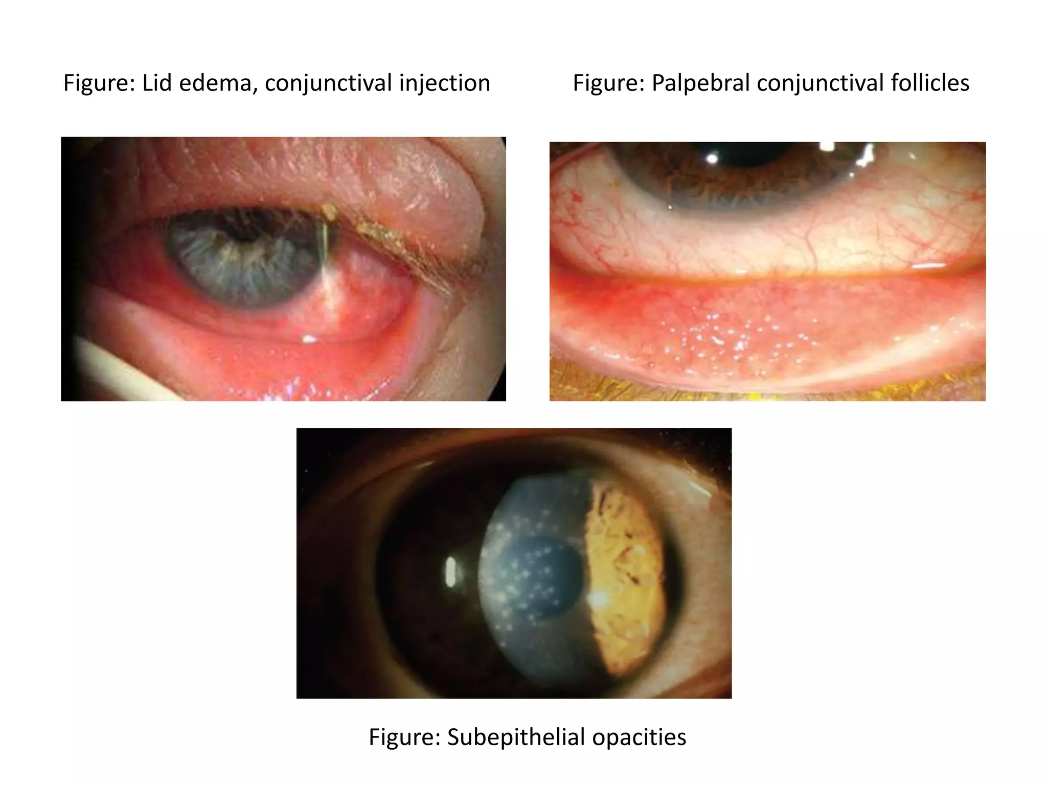 Lecture on Infective Conjunctivitis For 4th Year MBBS Undergraduate ...
