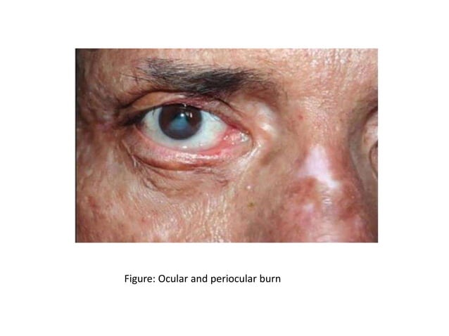 Lecture on Ocular Burn & Chemical Injuries For 4th Year MBBS ...