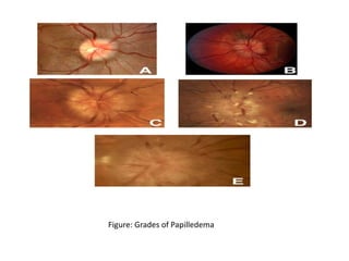 Lecture on Optic Neuritis & Papilledema For 4th Year MBBS Undergraduate ...