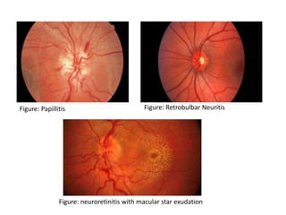 Lecture on Optic Neuritis & Papilledema For 4th Year MBBS Undergraduate ...