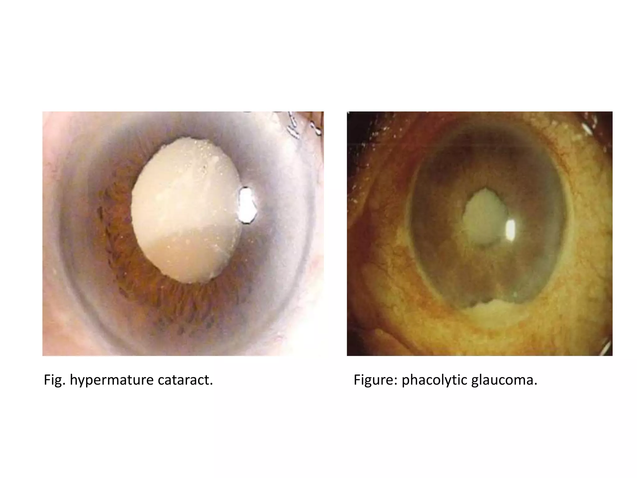 Lecture on Secondary Glaucoma Due to Hypermature Cataract For 4th Year ...