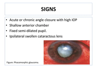 Lecture on Secondary Glaucoma Due to Hypermature Cataract For 4th Year ...