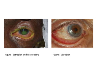 Lecture on Trichiasis, Entropion & Ectropion For 4th Year MBBS ...