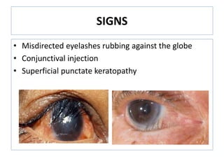 Lecture on Trichiasis, Entropion & Ectropion For 4th Year MBBS ...