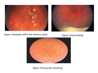 Lecture on Uveitis For 4th Year MBBS Undergraduate Students By Prof. Dr ...
