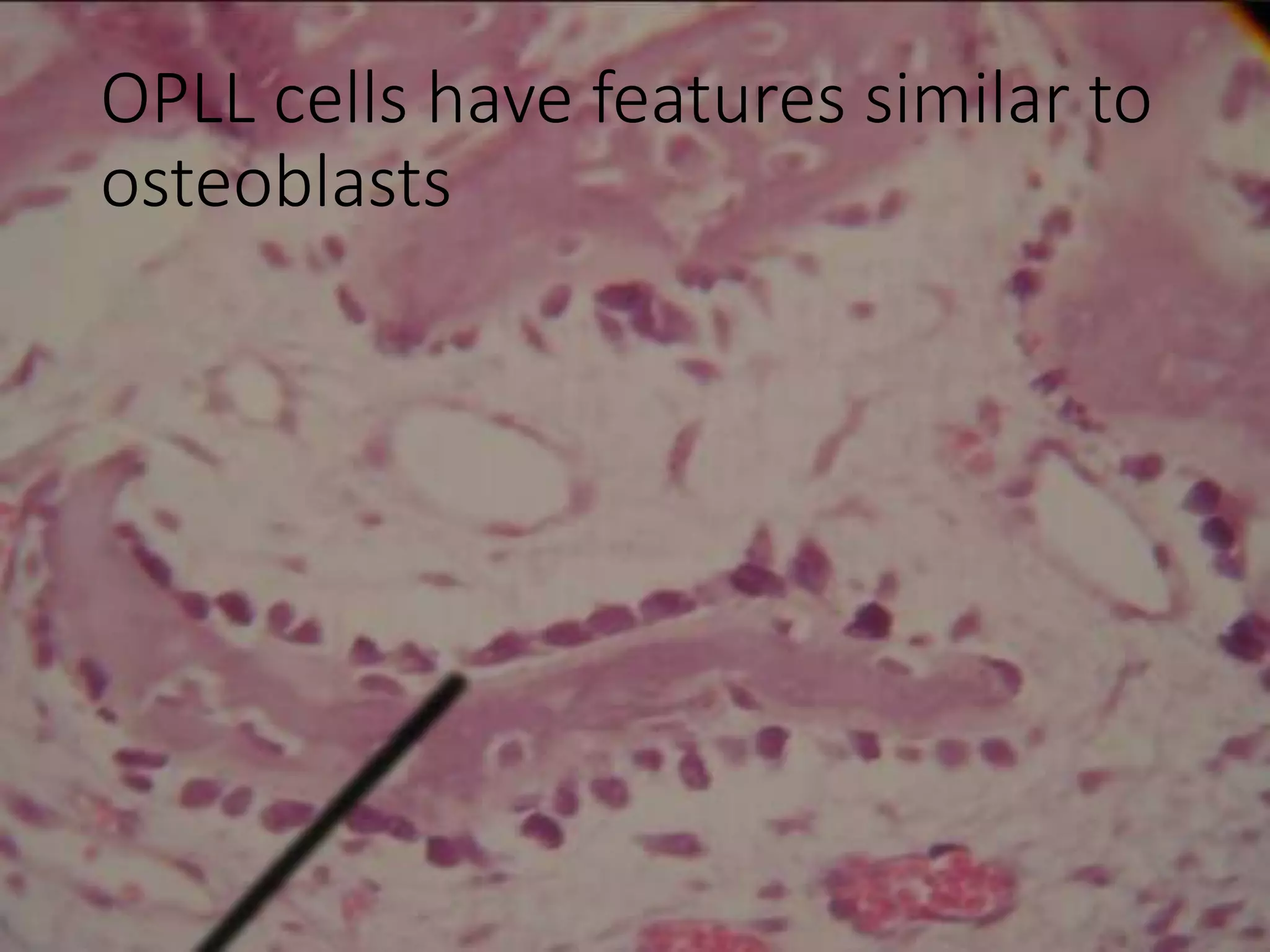 Lecture posterior fusion for ossification of the posterior longitudinal ...