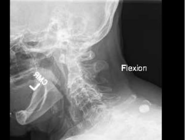 Lecture posterior fusion for ossification of the posterior longitudinal ...