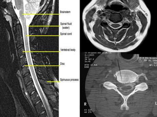 Lecture posterior fusion for ossification of the posterior longitudinal ...