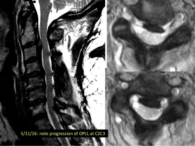 Lecture OPLL progressive