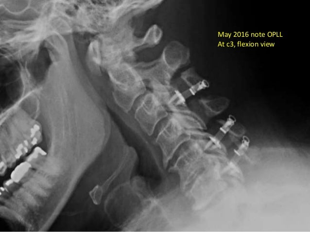 Lecture OPLL progressive