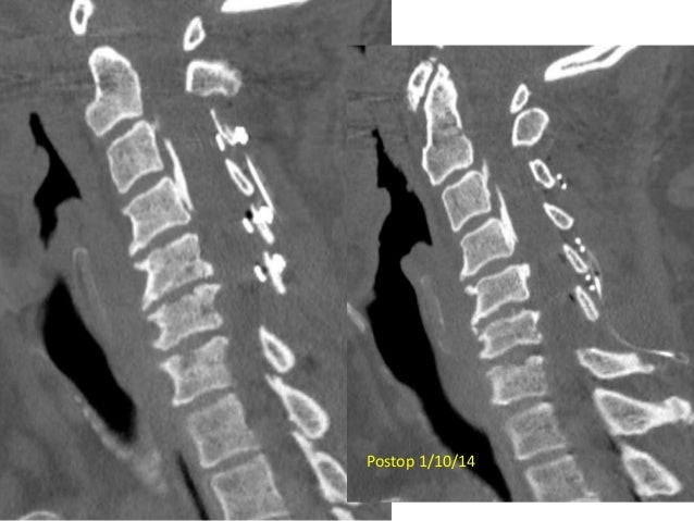 Lecture OPLL progressive