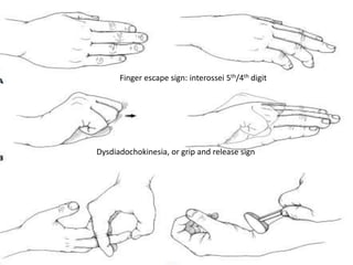 Finger Escape Sign