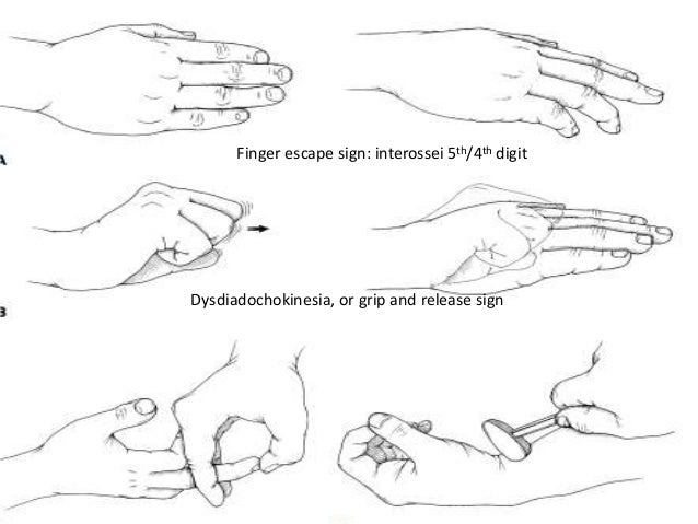 Revision Posterior Cervical Laminoplasty