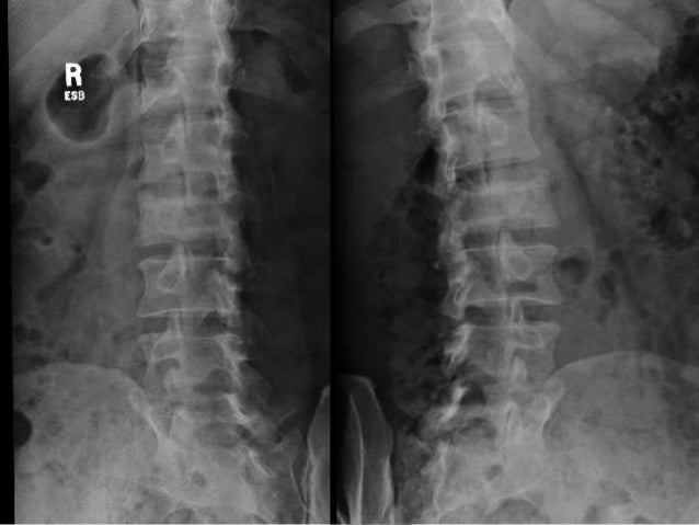 Lecture paget’s disease of the spine