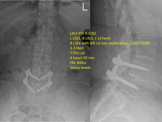 Preventing surgical site infections in spinal surgery | PPT