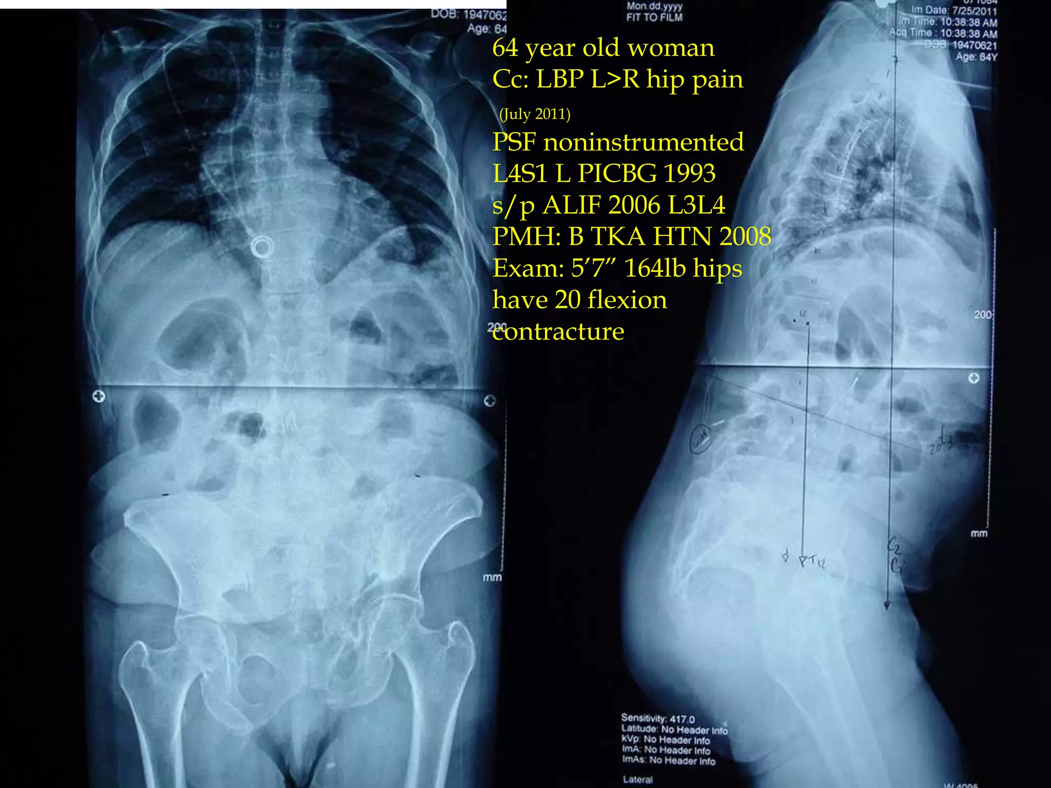 Proximal Junction Kyphosis of the spine | PPTX