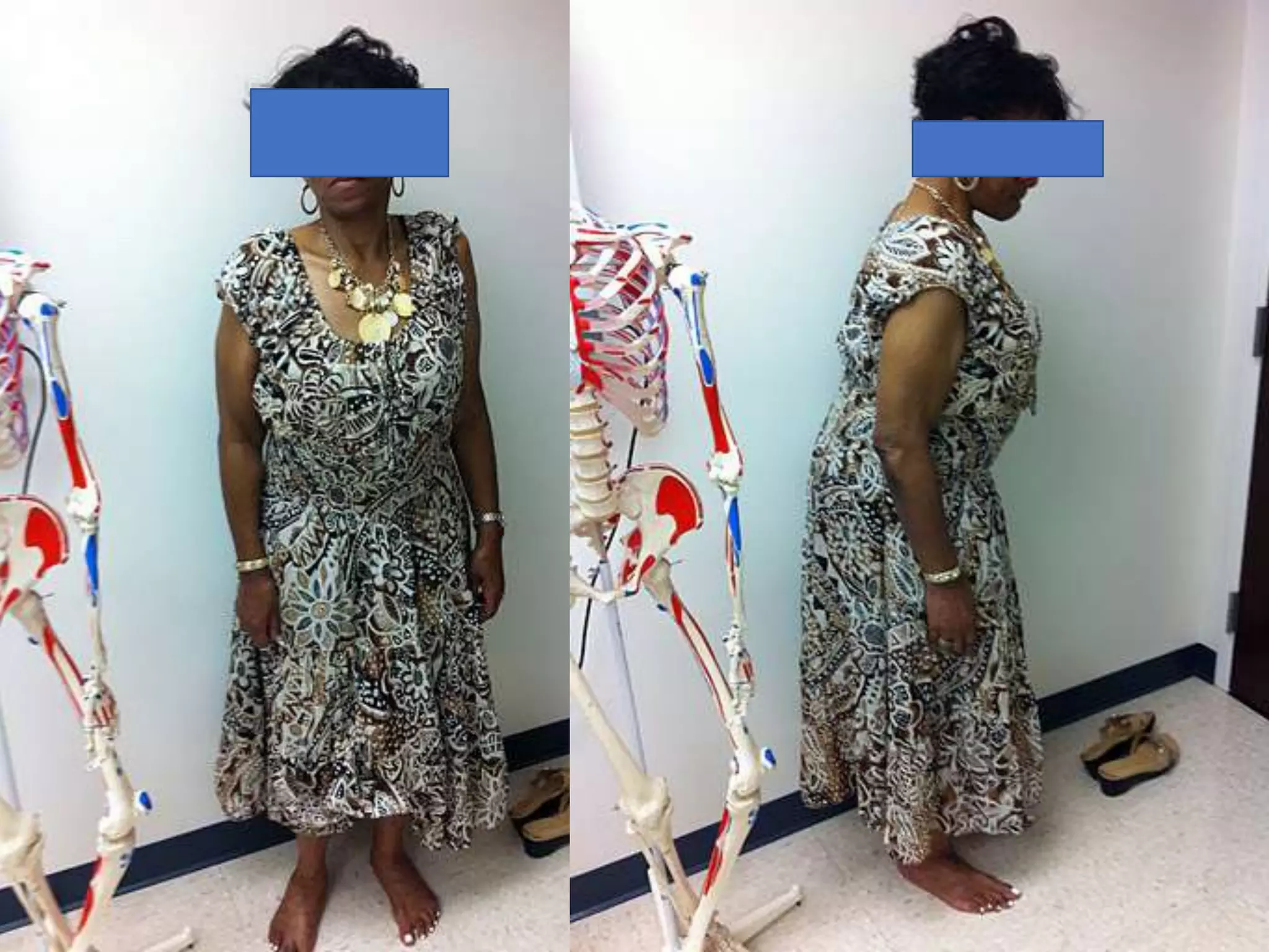 Proximal Junction Kyphosis of the spine | PPTX