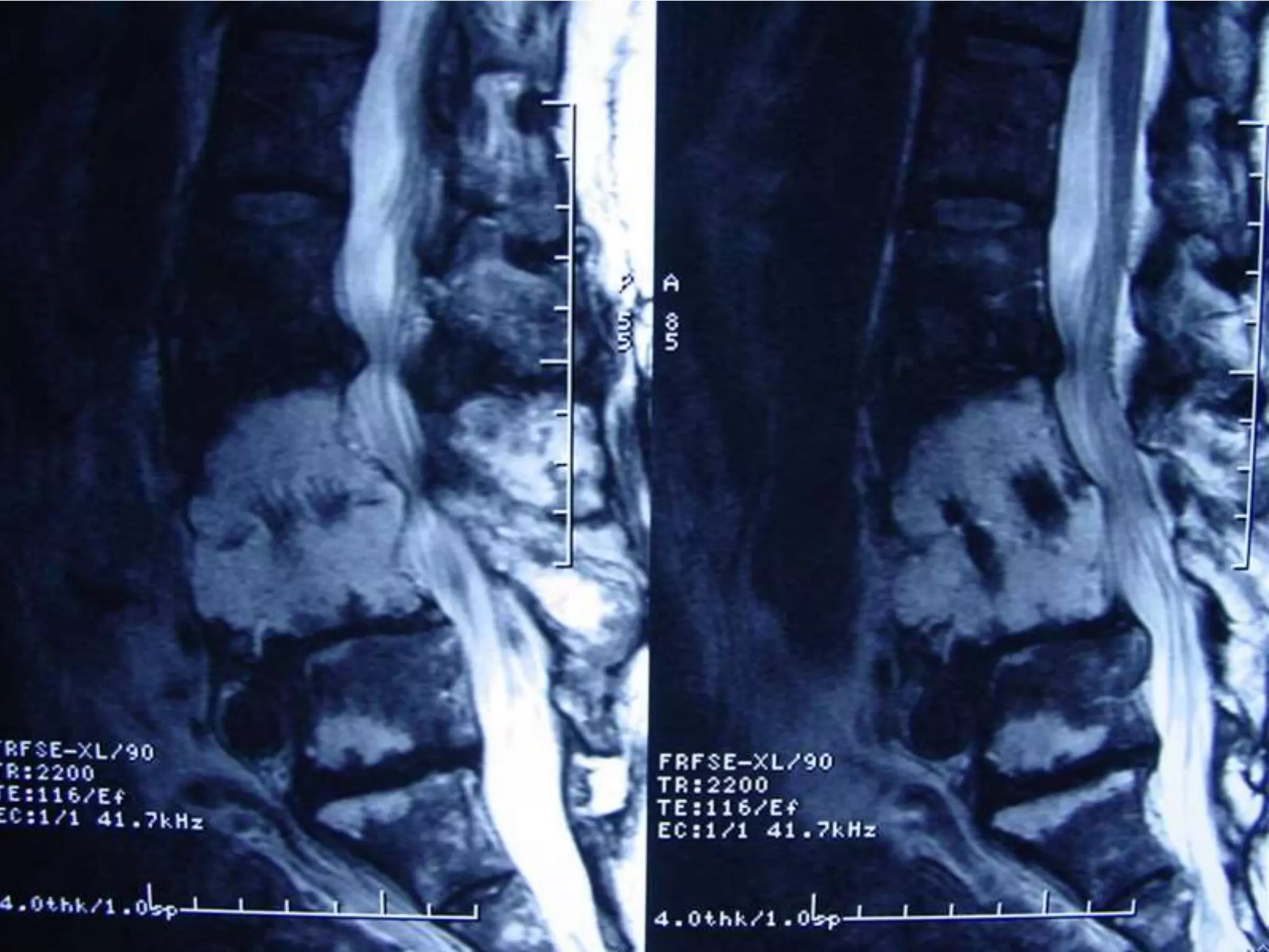 Proximal Junction Kyphosis of the spine | PPTX