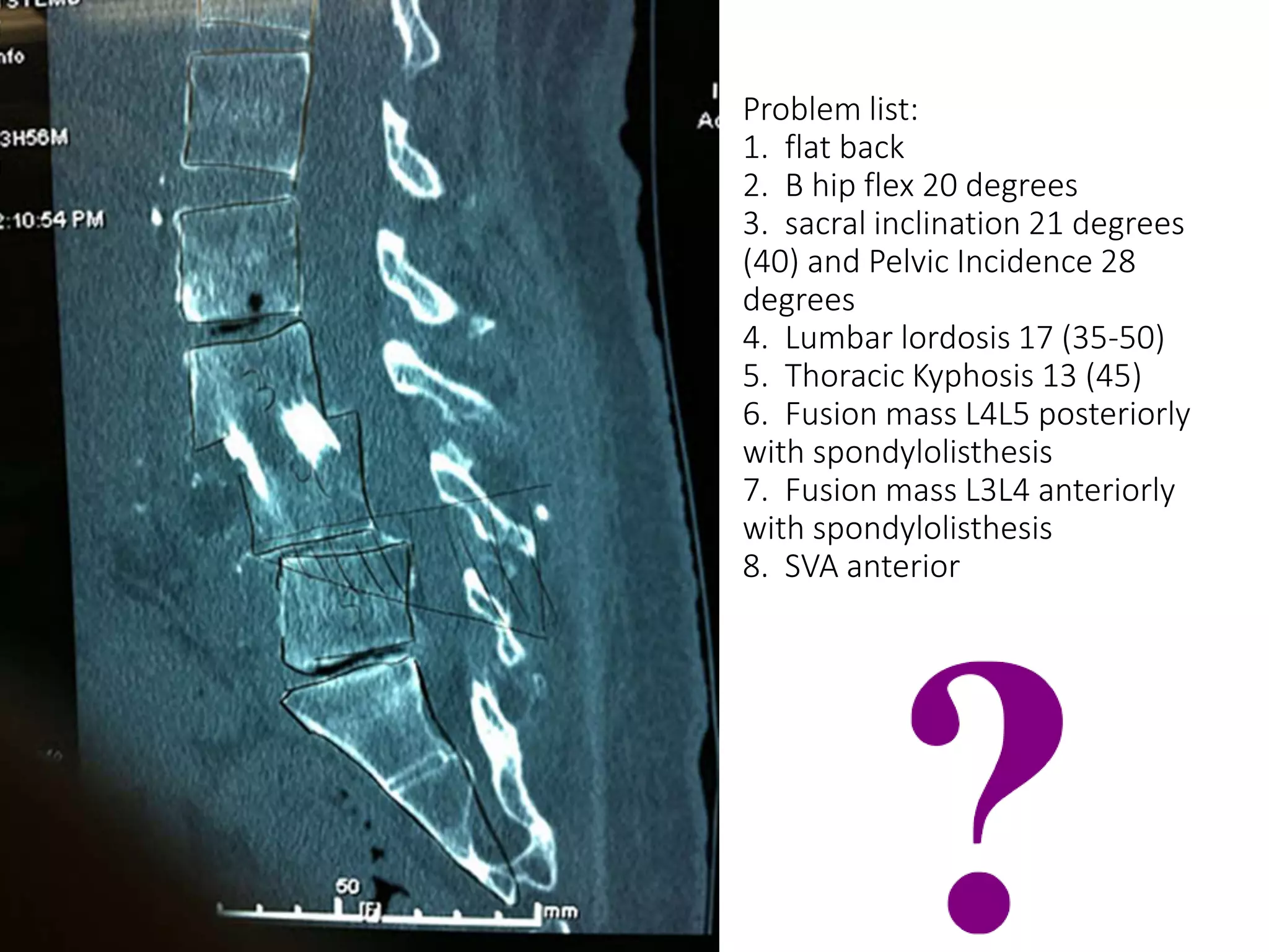 Proximal Junction Kyphosis of the spine | PPTX