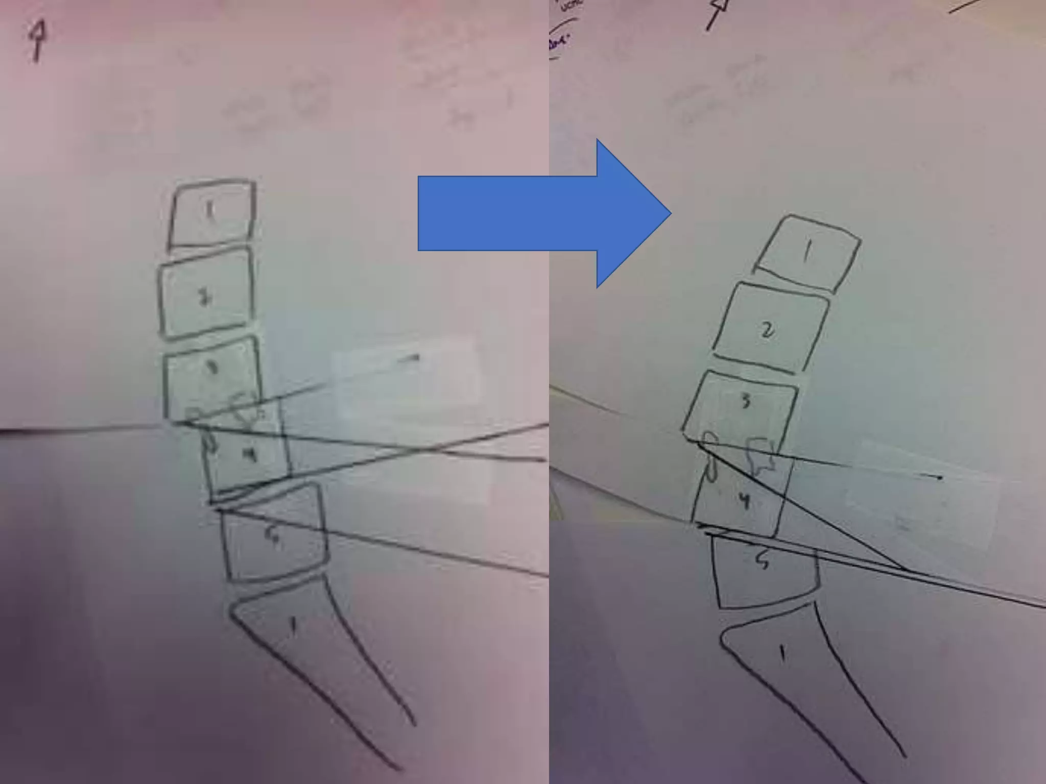Proximal Junction Kyphosis of the spine | PPTX
