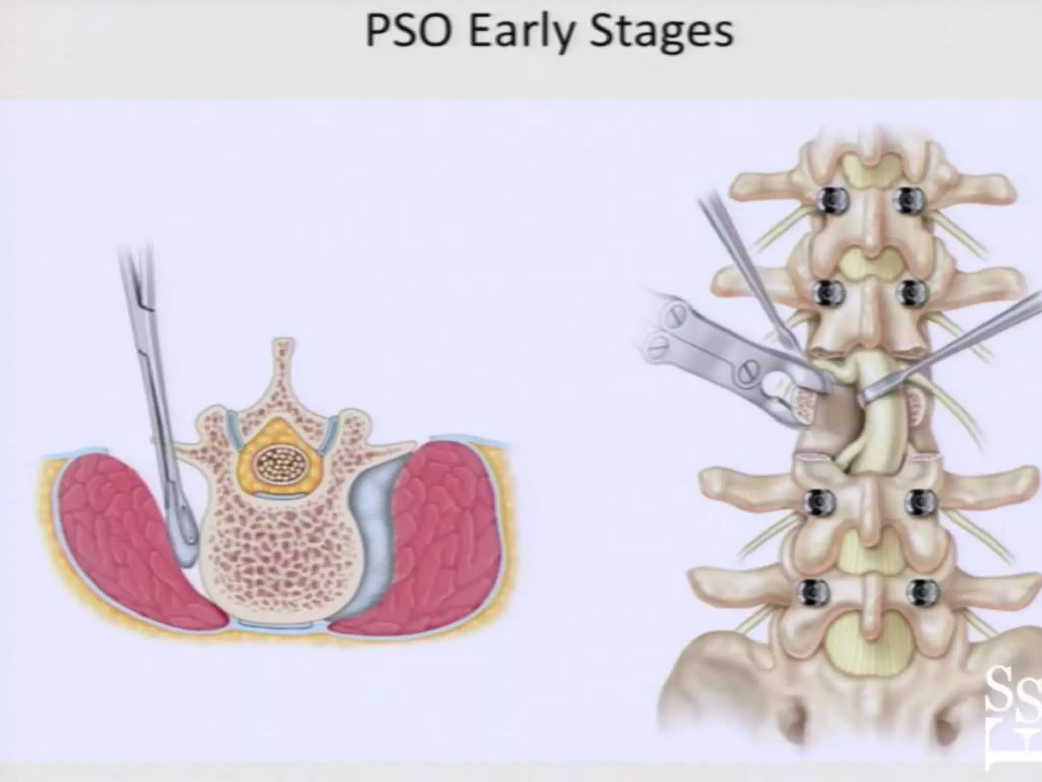 Proximal Junction Kyphosis of the spine | PPTX