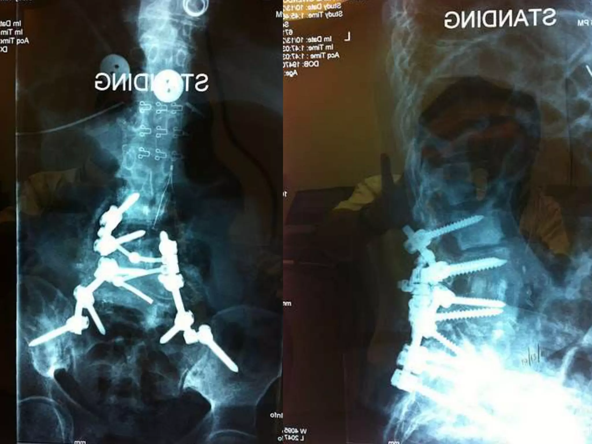 Proximal Junction Kyphosis of the spine | PPTX