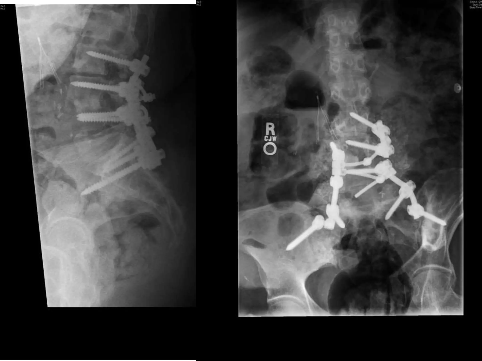 Proximal Junction Kyphosis of the spine | PPTX