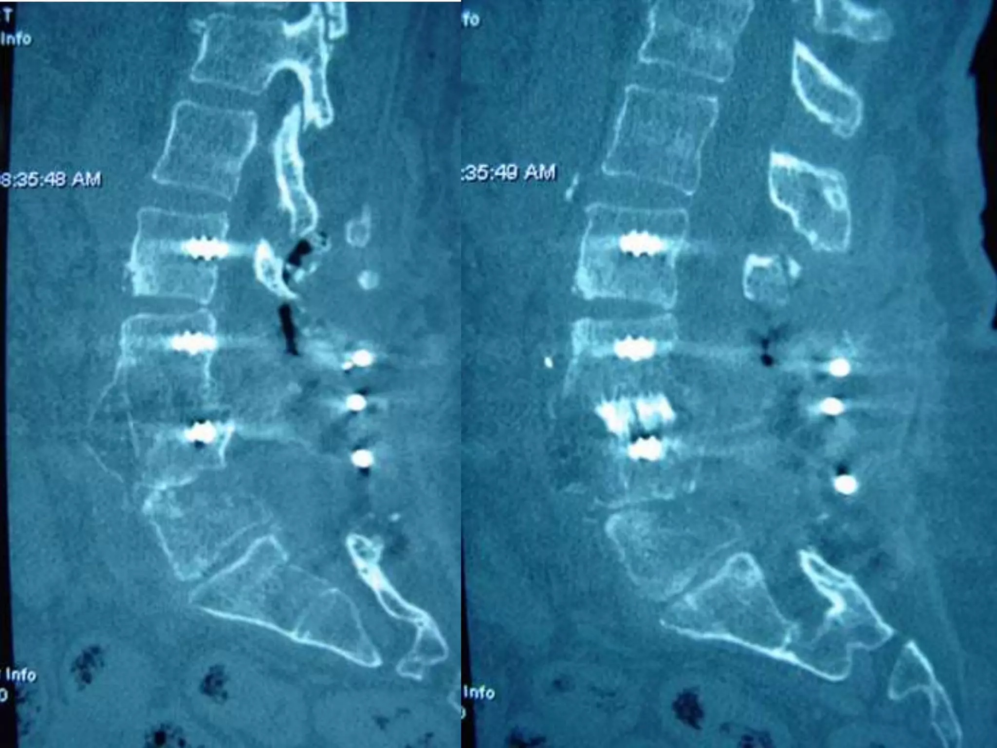 Proximal Junction Kyphosis of the spine | PPTX