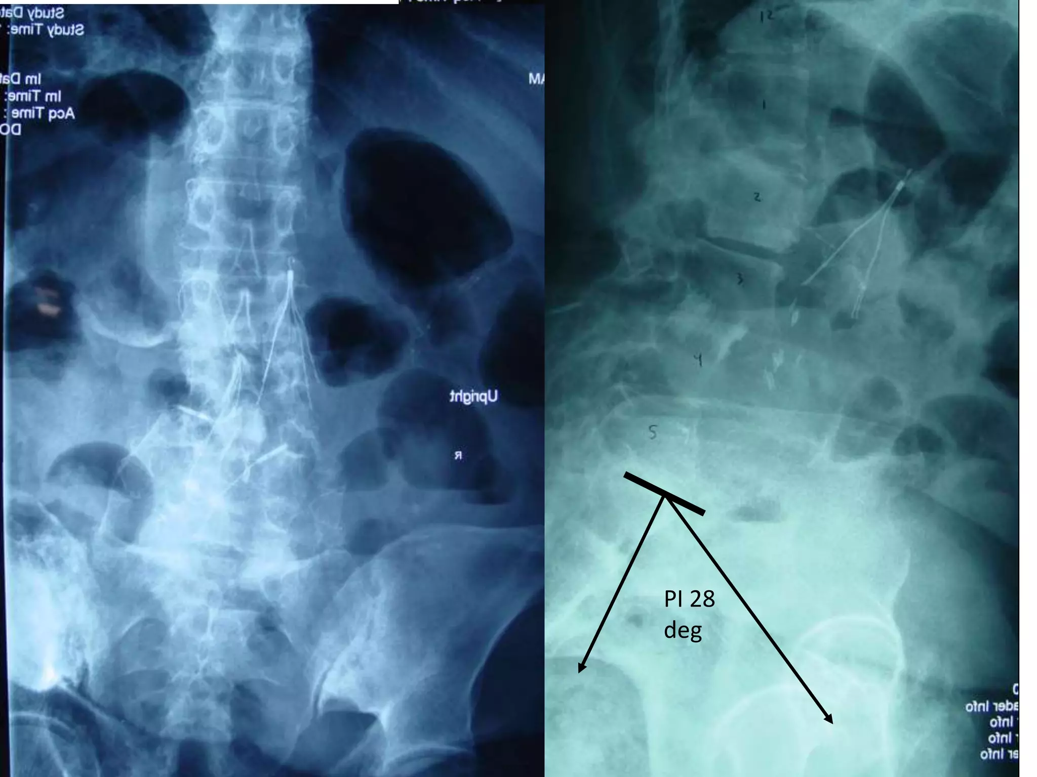 Proximal Junction Kyphosis of the spine | PPTX