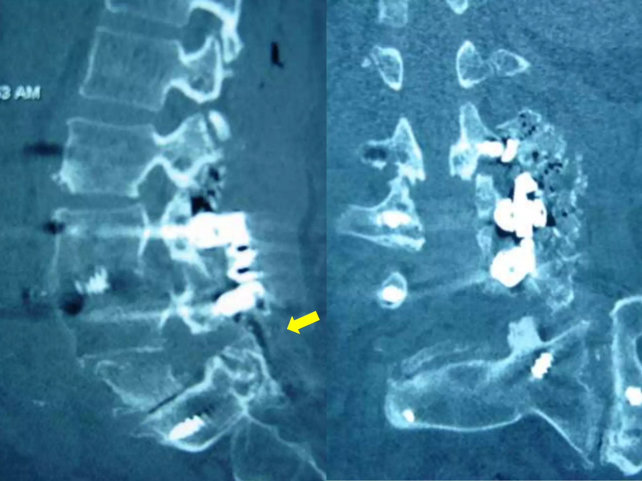 Proximal Junction Kyphosis of the spine | PPTX