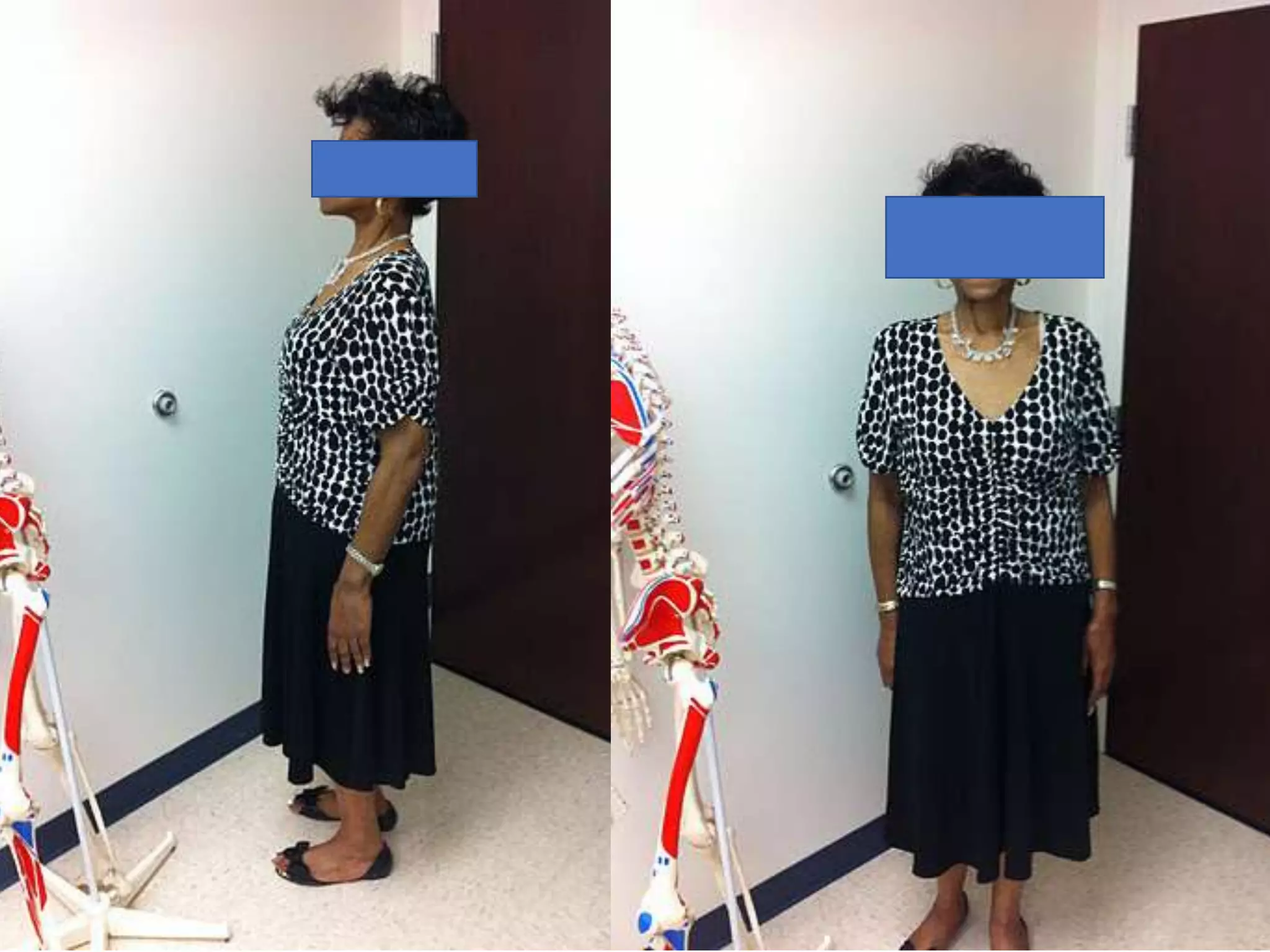 Proximal Junction Kyphosis of the spine | PPTX
