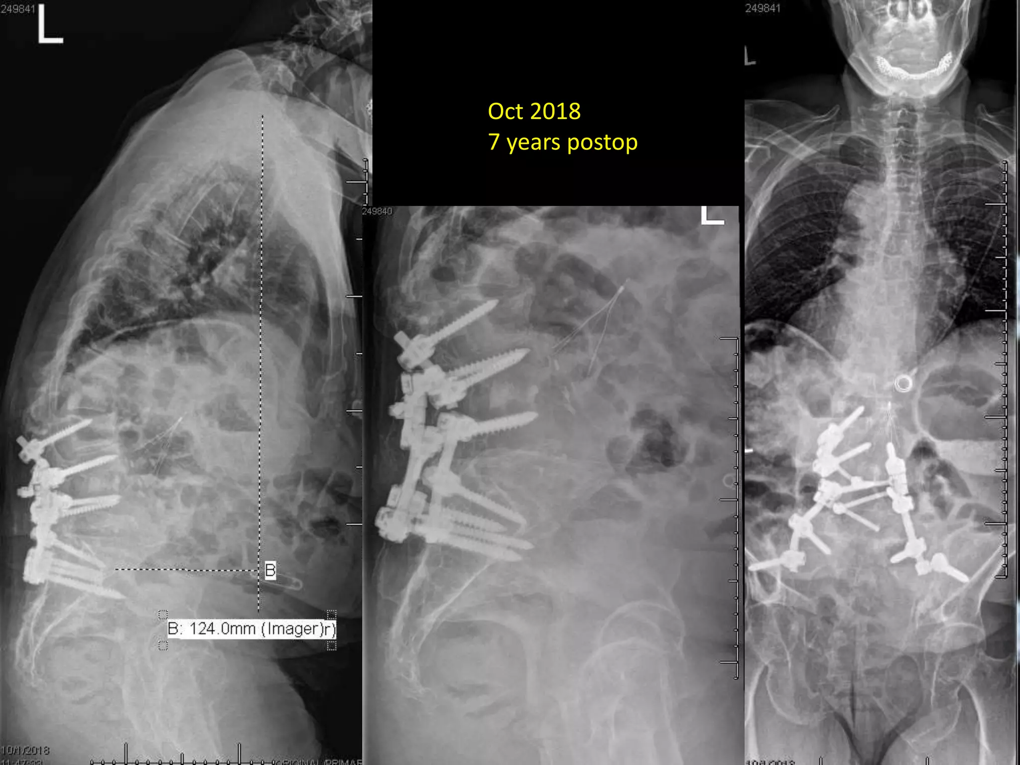 Proximal Junction Kyphosis of the spine | PPTX