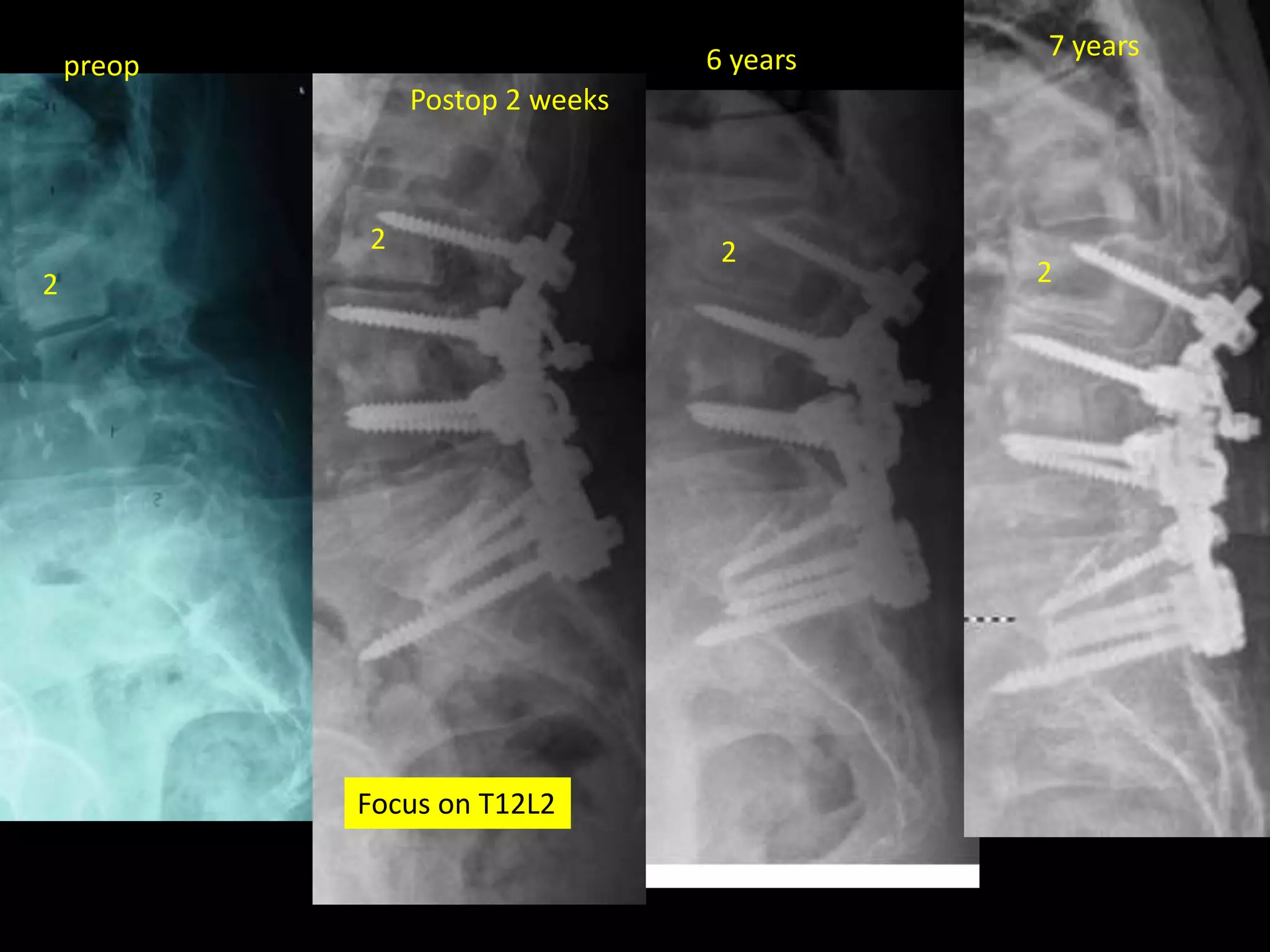 Proximal Junction Kyphosis of the spine | PPTX