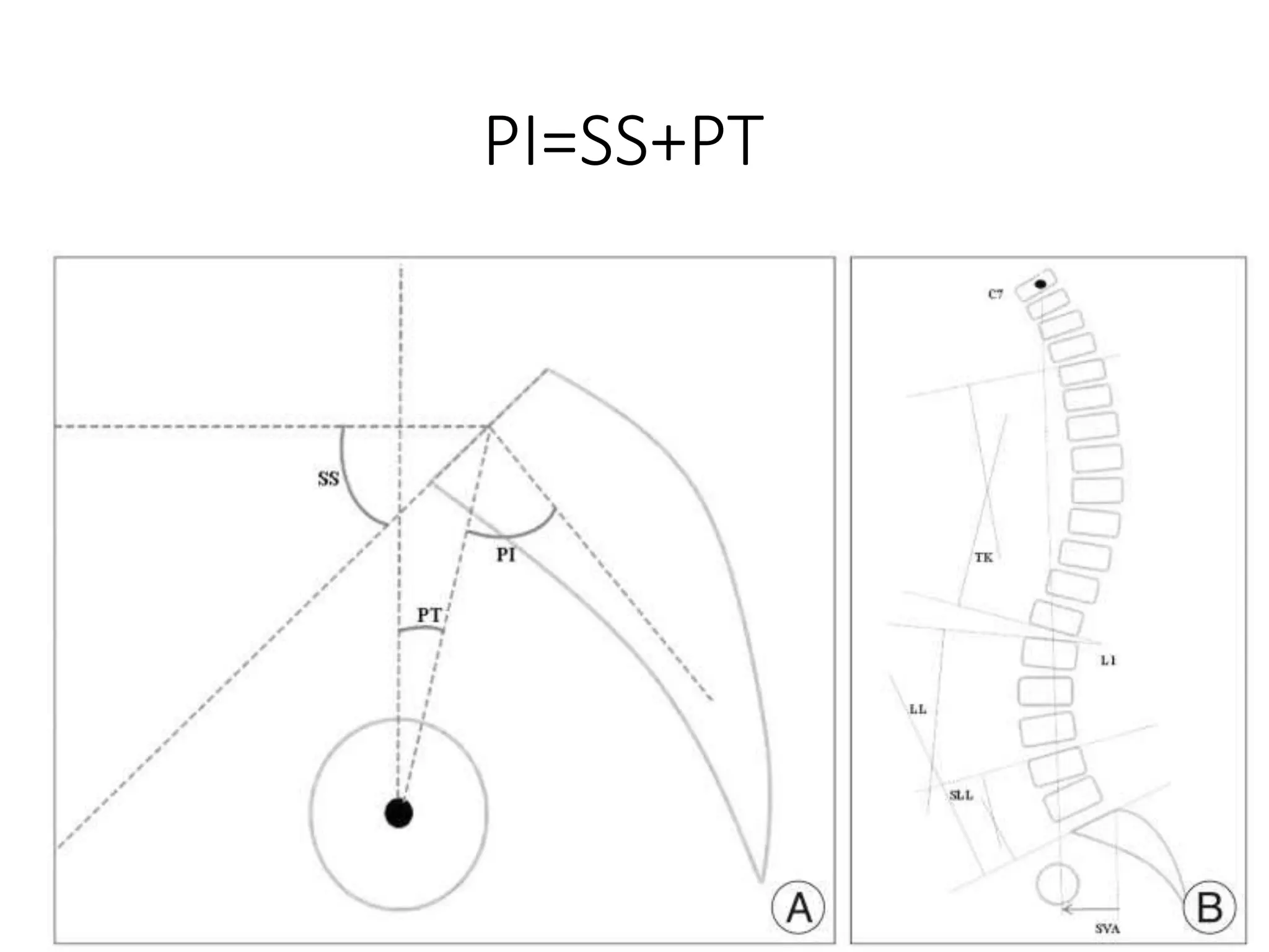 Proximal Junction Kyphosis of the spine | PPTX