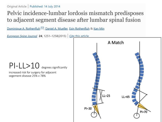 Proximal Junction Kyphosis of the spine | PPTX