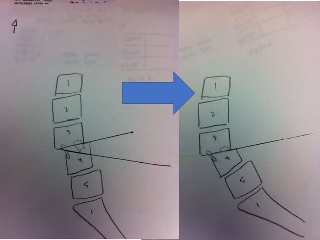 Proximal Junction Kyphosis of the spine | PPTX