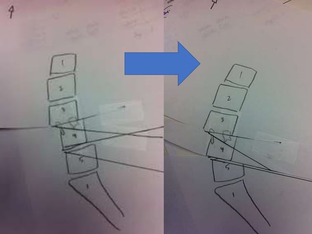 Proximal Junction Kyphosis of the spine | PPTX