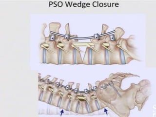Proximal Junction Kyphosis of the spine | PPTX