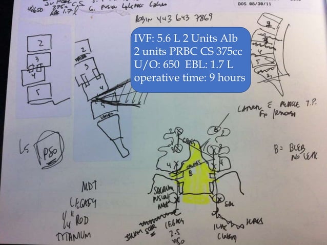 Proximal Junction Kyphosis of the spine | PPTX