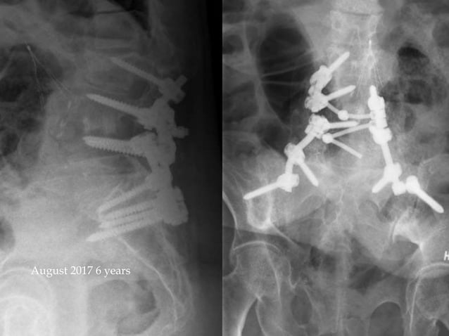 Proximal Junction Kyphosis of the spine | PPTX