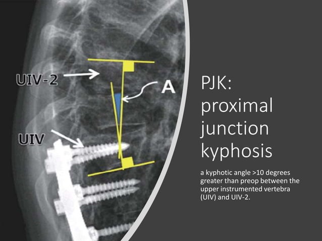 Proximal Junction Kyphosis of the spine | PPTX