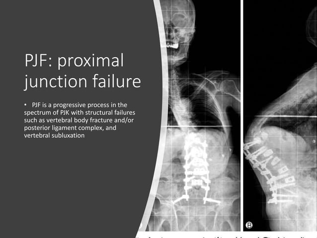 Proximal Junction Kyphosis of the spine | PPTX