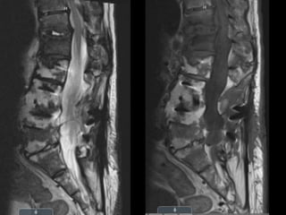 Proximal Junction Kyphosis of the spine | PPTX
