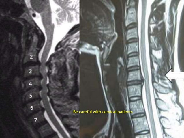 Lecture positioning for spinal surgery | PPT