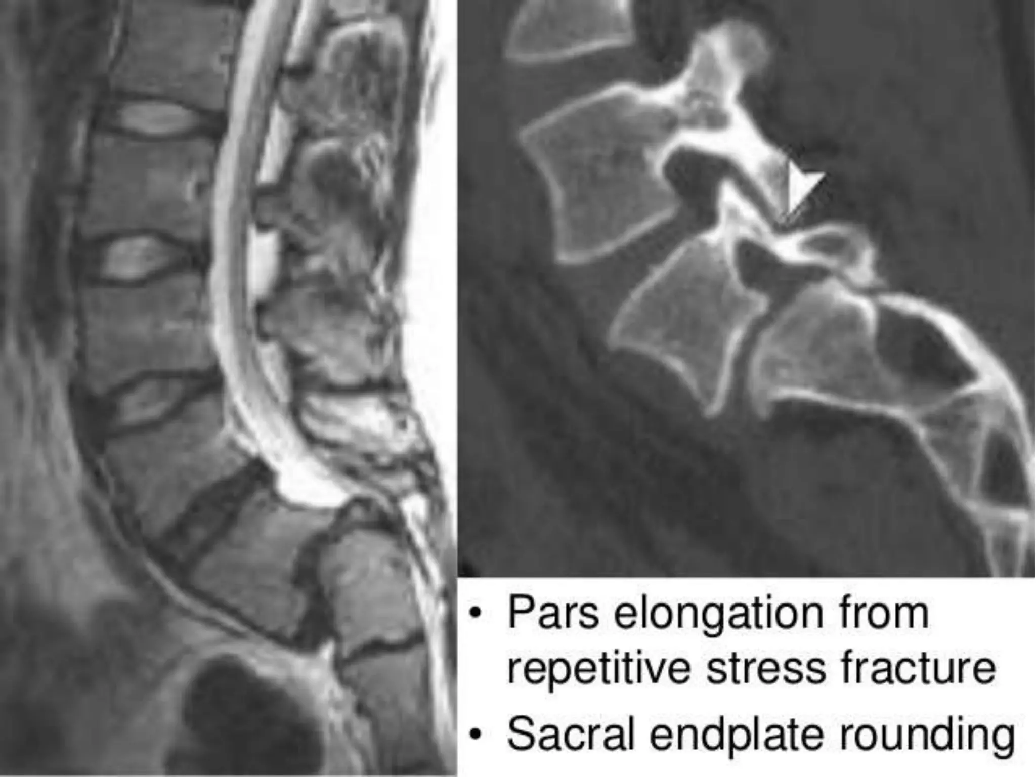 Lecture post laminectomy spondylisthesis with pars fracture 2017 may | PPT