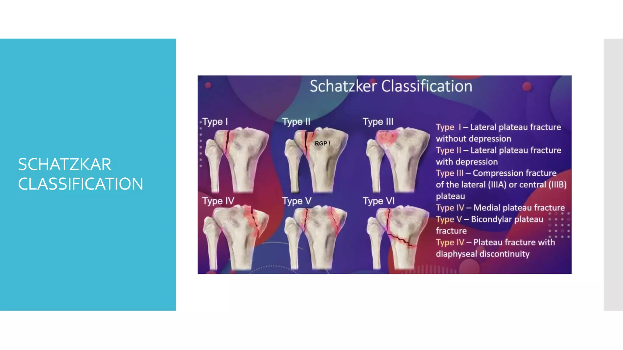 fractures of proximal tibia.pptx