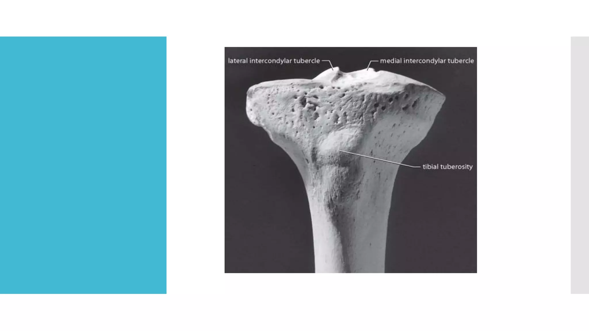fractures of proximal tibia.pptx