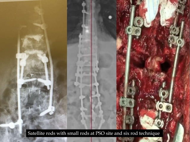spine Lecture pso | PPT