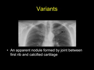 basic approach for CXR interpretation | PPTX