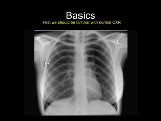 basic approach for CXR interpretation | PPTX